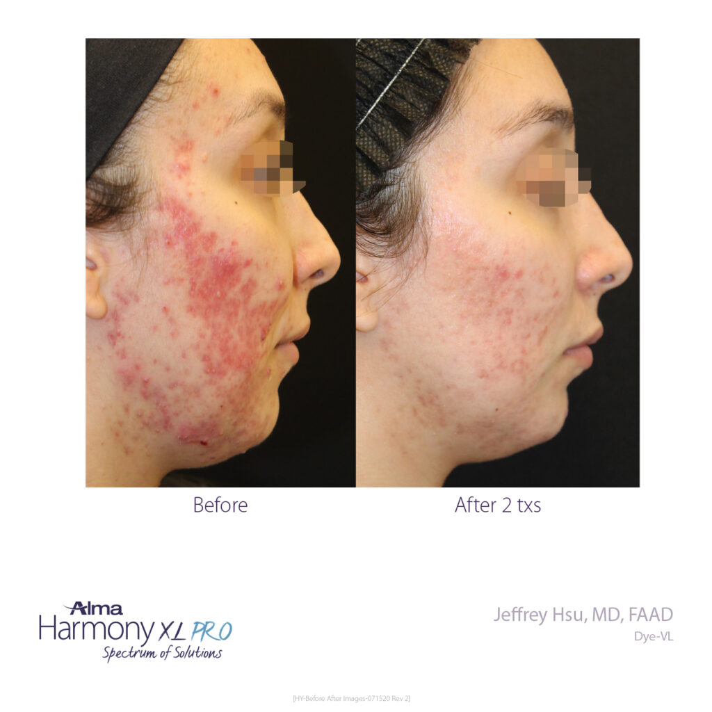 Acne Scar Removal | Wisconsin Institute of Plastic Surgery